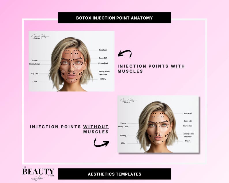 Botox Injection Points, Botox Injectors, Facial Anatomy, Art ...