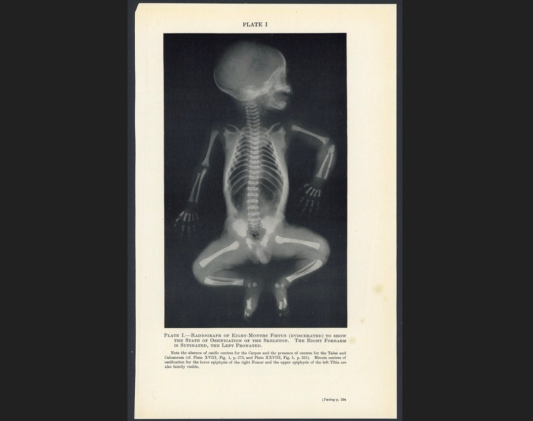 C. 1937 FETUS XRAY Lithograph • Original Vintage Print • Fetal Anatomy ...