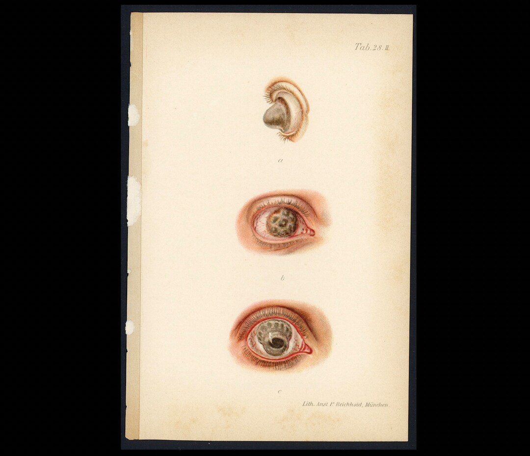 EYE DISEASE Lithograph C. 1901 • Original Antique Print • Medical ...