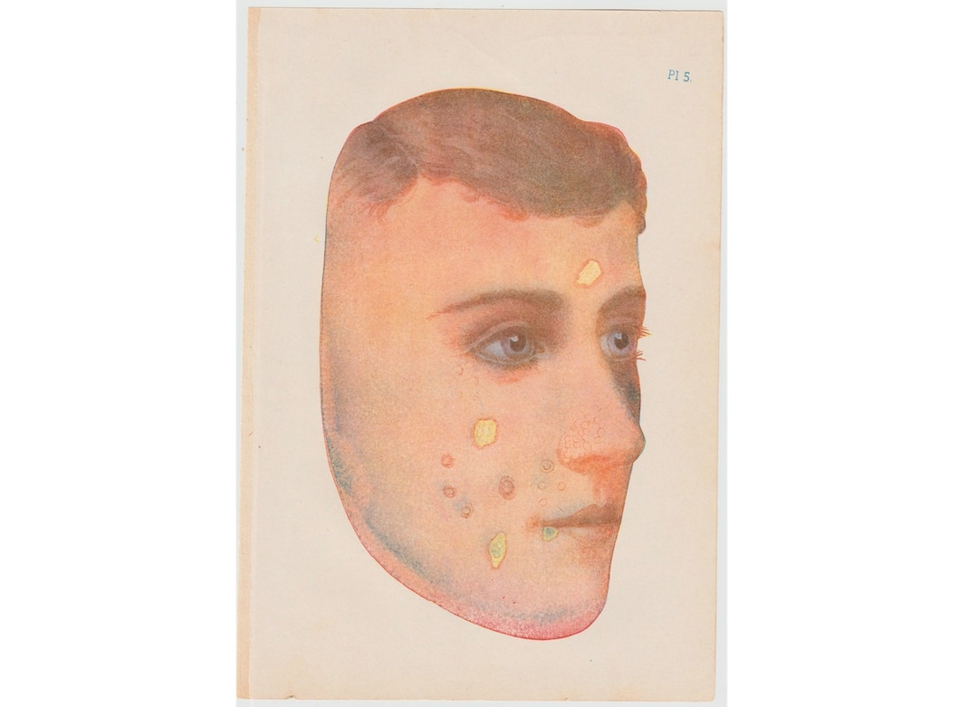 C. 1926 SYPHILIS Lithograph • Original Antique Print • Medical ...