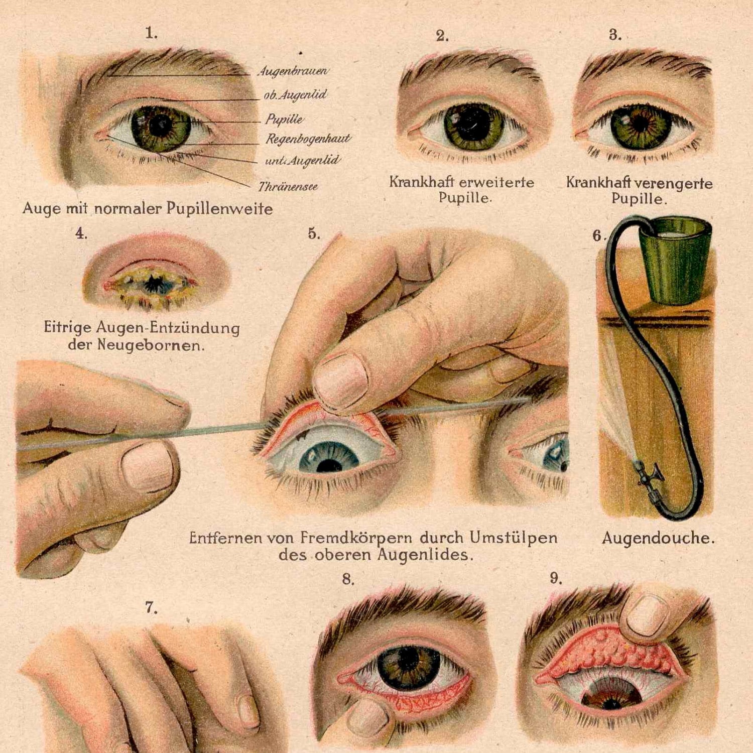 C. 1921 EYE ANATOMY and DISEASE lithograph original antique print ...