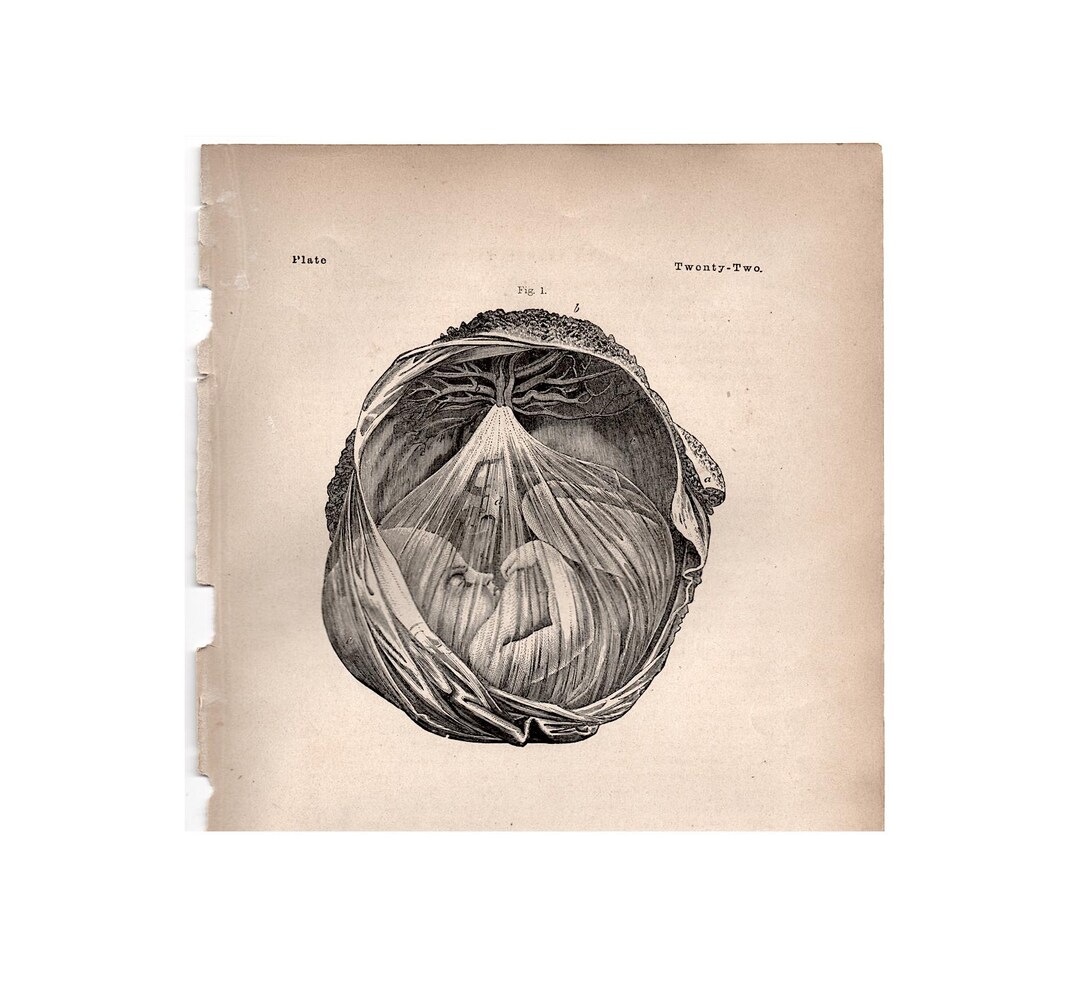C. 1860 FETUS IN WOMB Lithograph • Original Antique Print • Obgyn ...