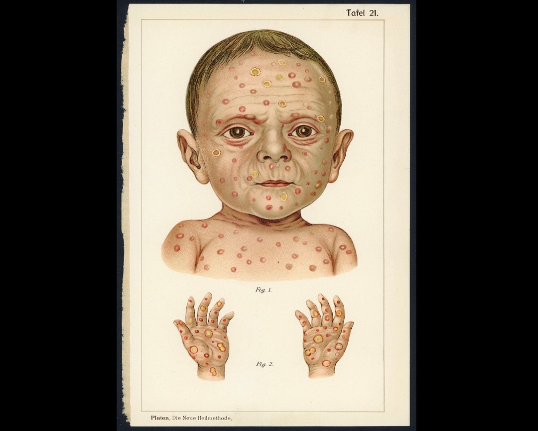 C. 1902 SYPHILIS at 4 Days Old Lithograph Original Antique Print STD ...