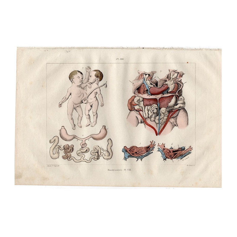 Conjoined Twin - Etsy
