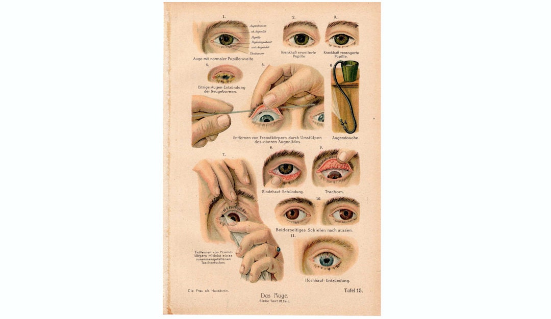 EYE ANATOMY & DISEASE Lithograph C. 1921 • Original Antique Print ...