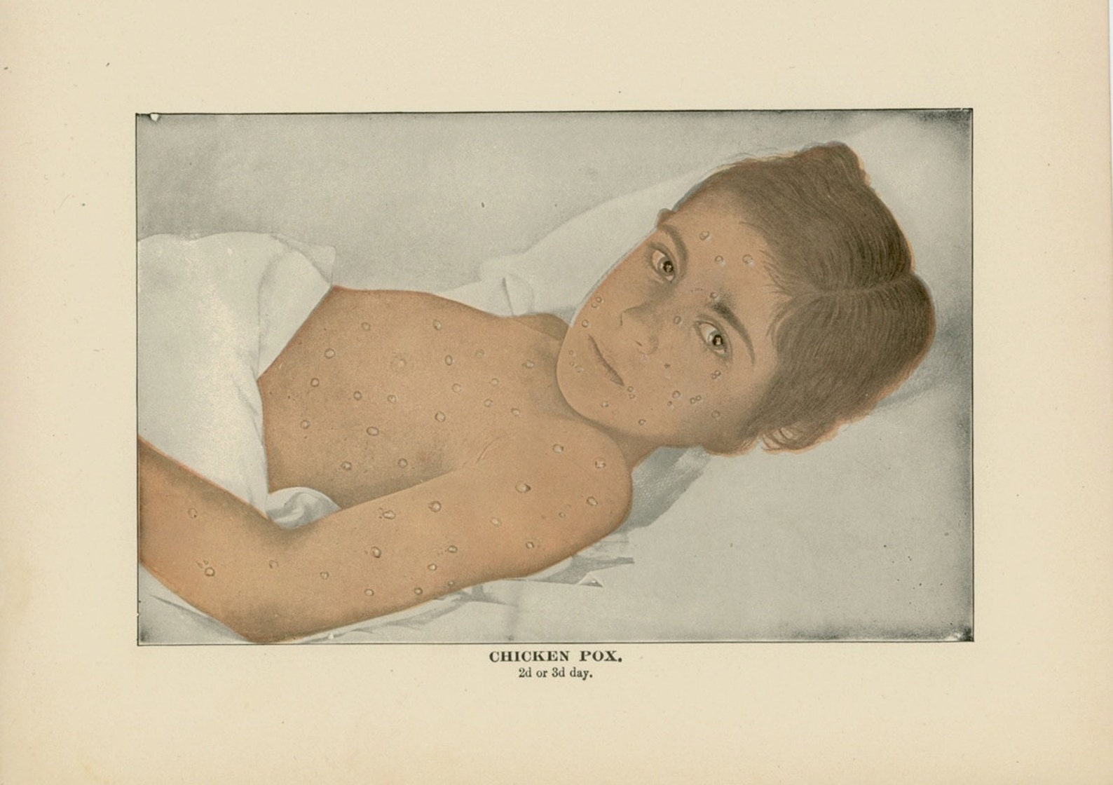 C. 1906 CHICKEN POX Lithograph - Original Antique Print • Infectious ...