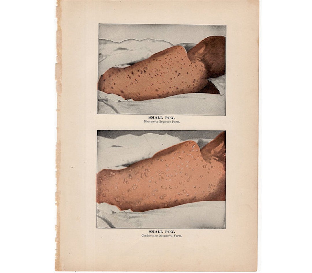 C. 1906 SMALLPOX Lithograph • Original Antique Print • Infectious ...