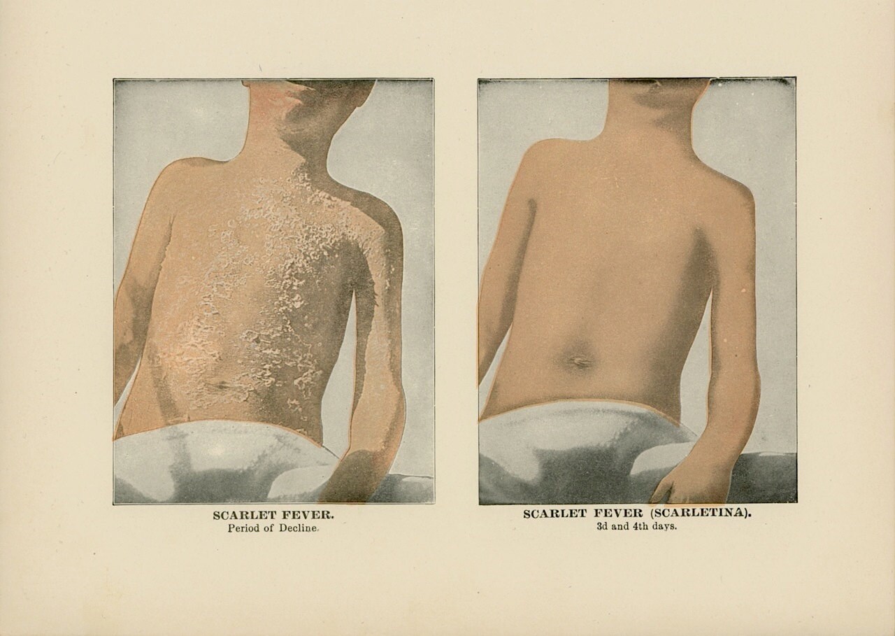 Scarlet Fever Cell Diagram