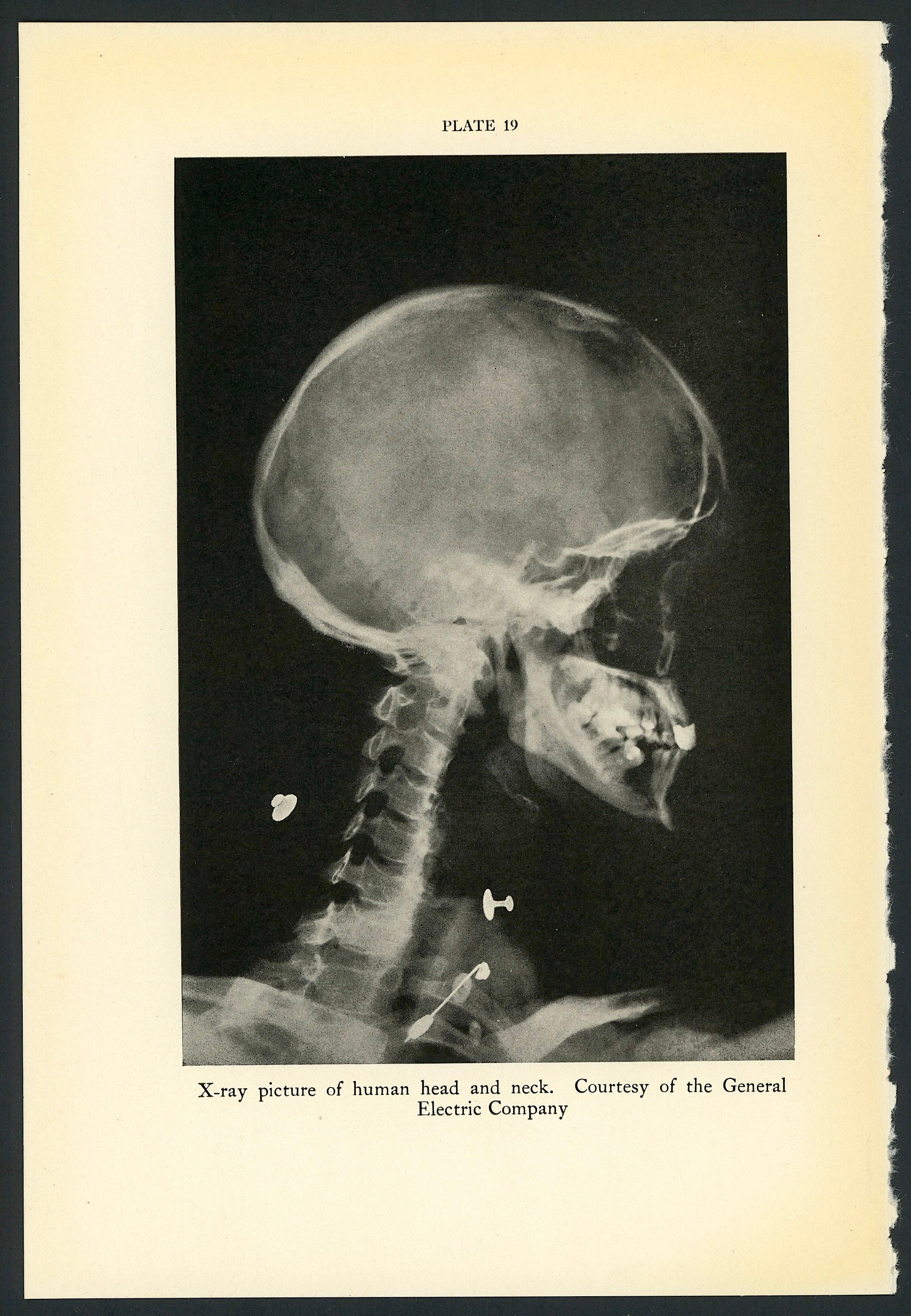 Xray Of Head
