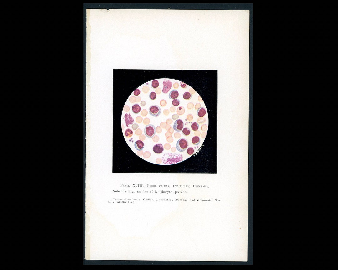 C. 1939 UNDER THE MICROSCOPE Lithograph • Blood Smear of Leukemia ...