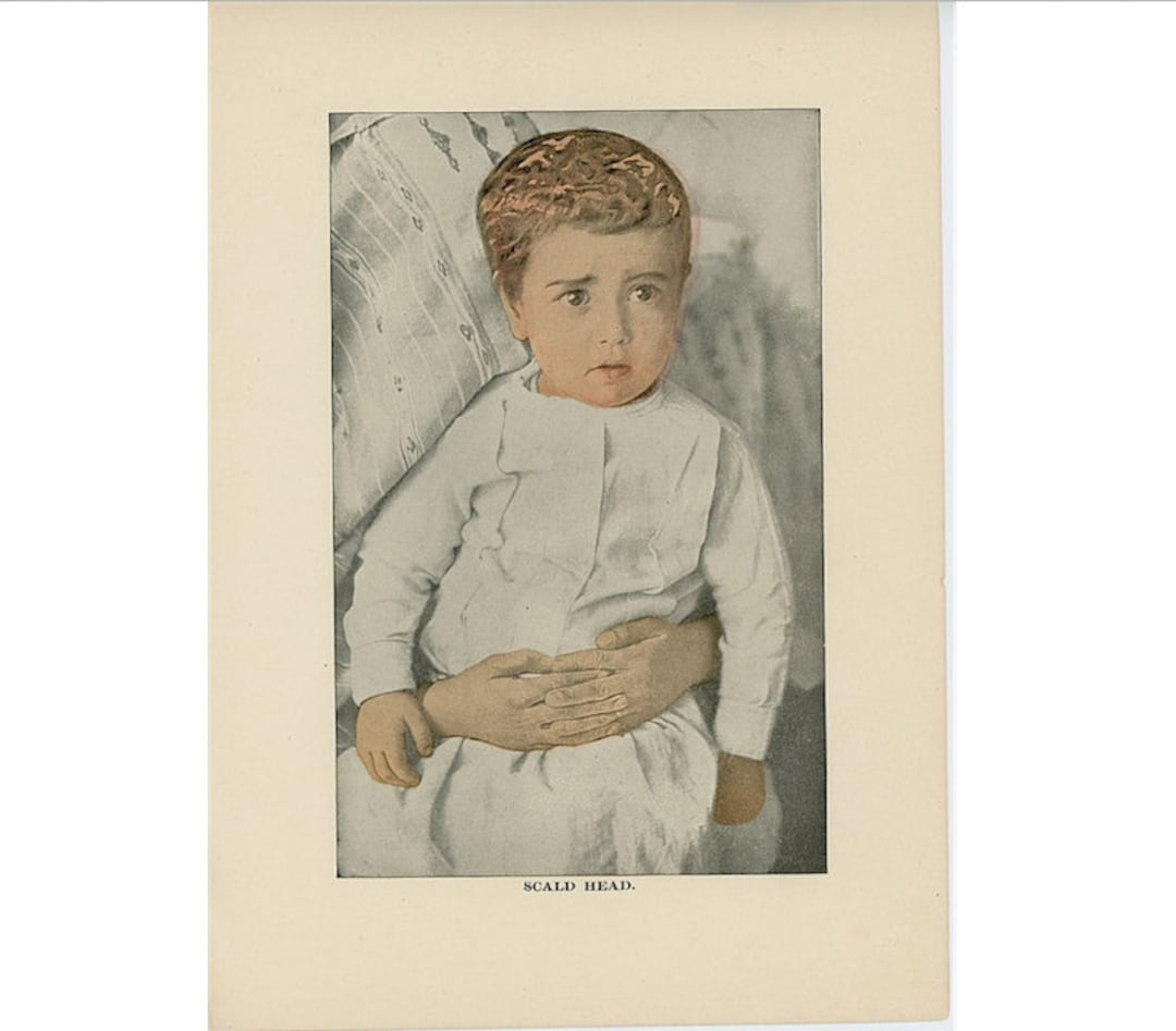 1906 Scald Head Human Anatomy Original Antique Disease Print - Etsy