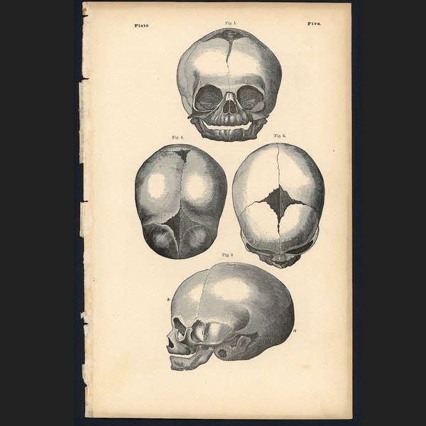Fetal Skull - Etsy