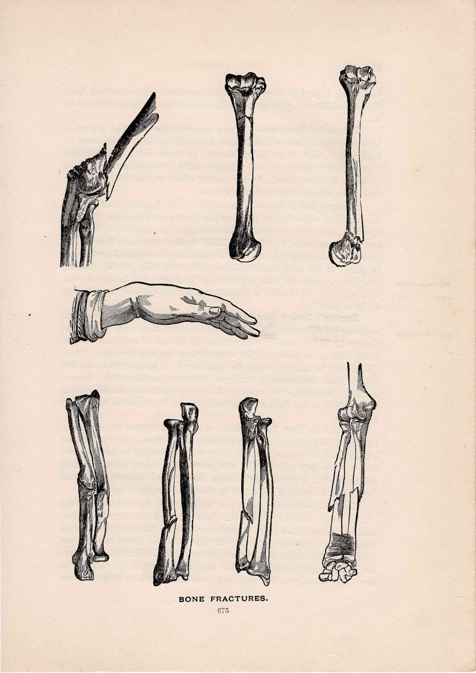 1903 HUMAN ANATOMY BONES Original Antique Anatomy Print of Bone ...