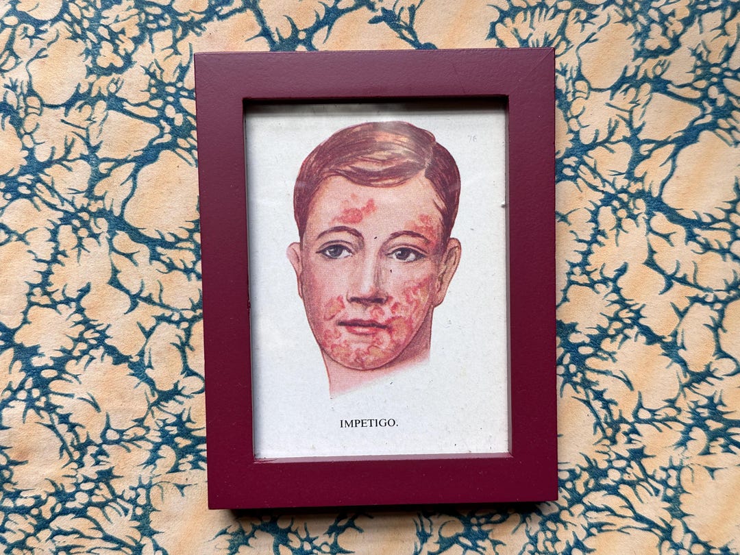 Framed C. 1940 IMPETIGO SKIN DISEASE Print • Original Vintage Print ...