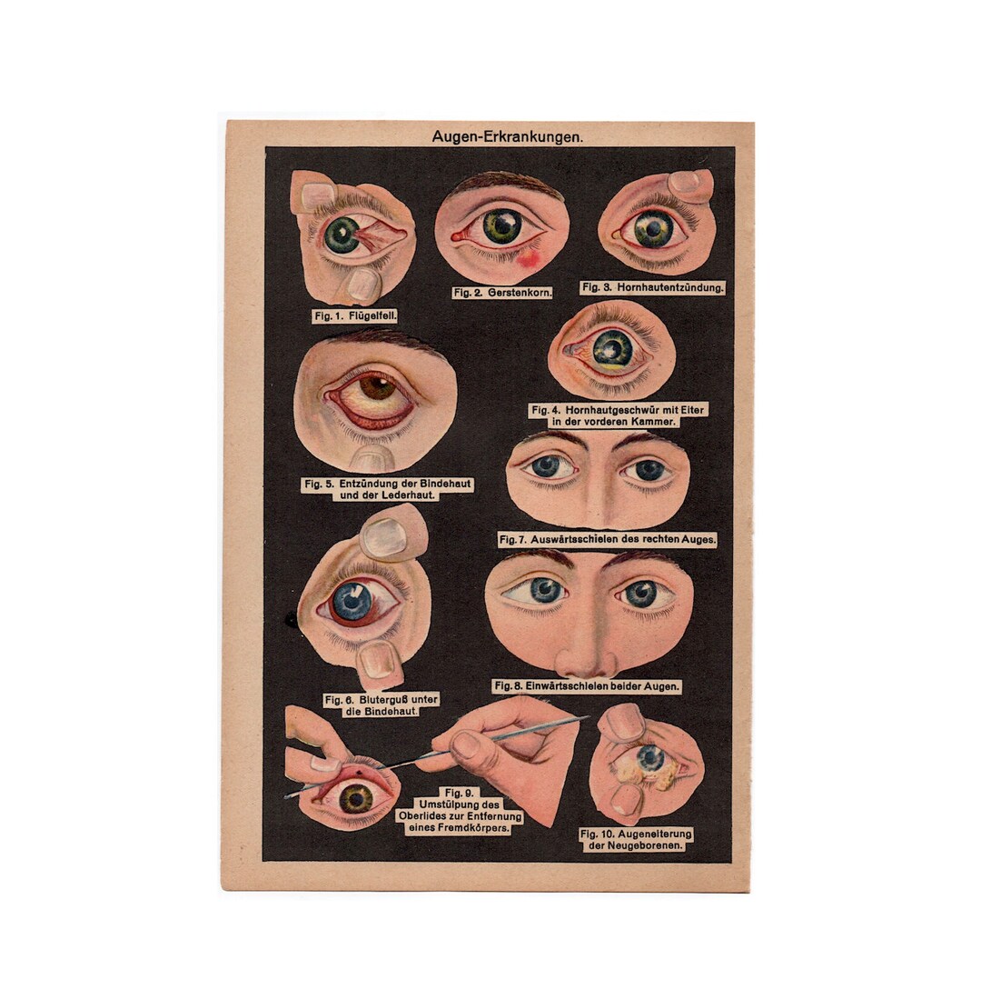 EYE DISEASES Lithograph C. 1929 • Original Antique Print • Medical ...