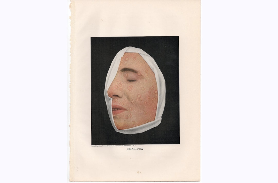 C. 1920 SMALLPOX Lithograph • Original Antique Print • Human Anatomy ...
