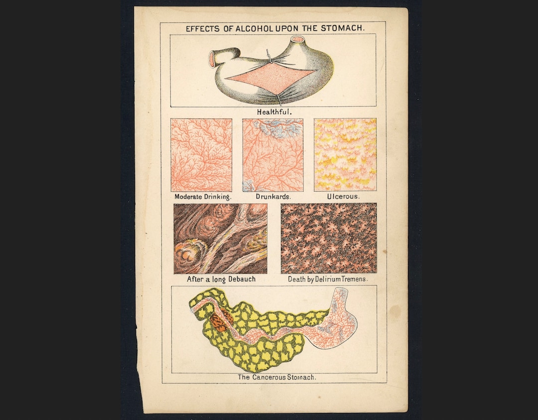 C. 1884 EFFECTS OF ALCOHOL on the Stomach Lithograph • Original Antique ...