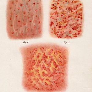 C. 1902 SKIN DISEASE Lithograph Syphilid Syphilis Infections Human ...
