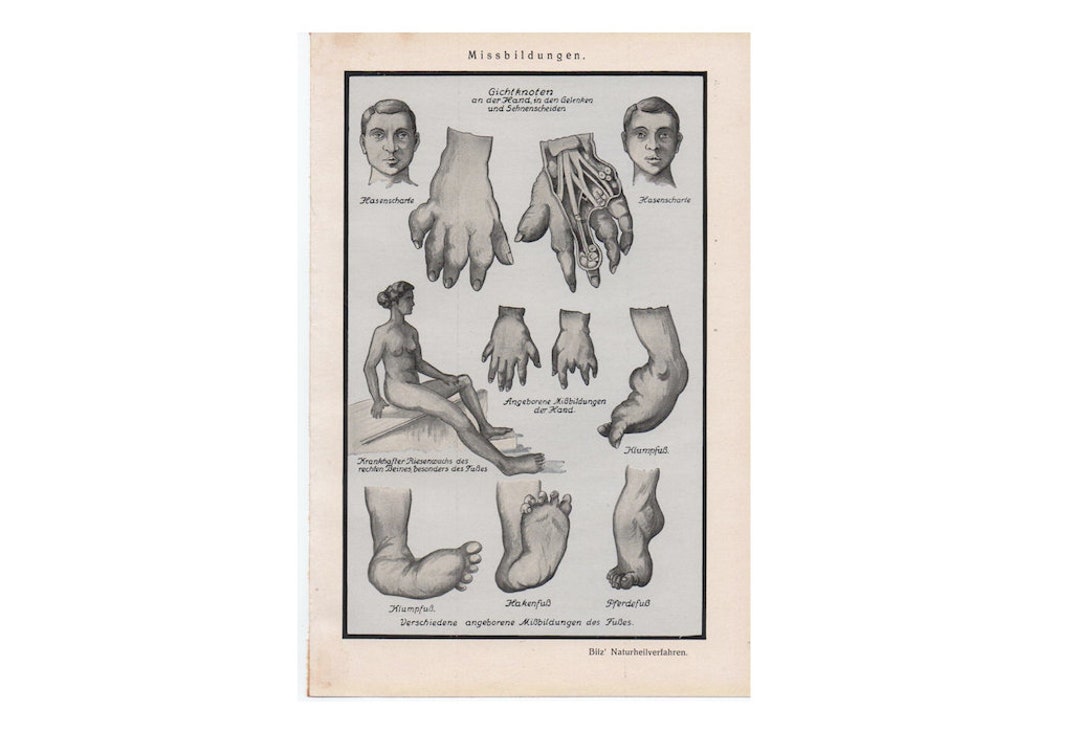 C. 1926 BIRTH DEFECTS Lithograph - Original Antique Medical Print ...