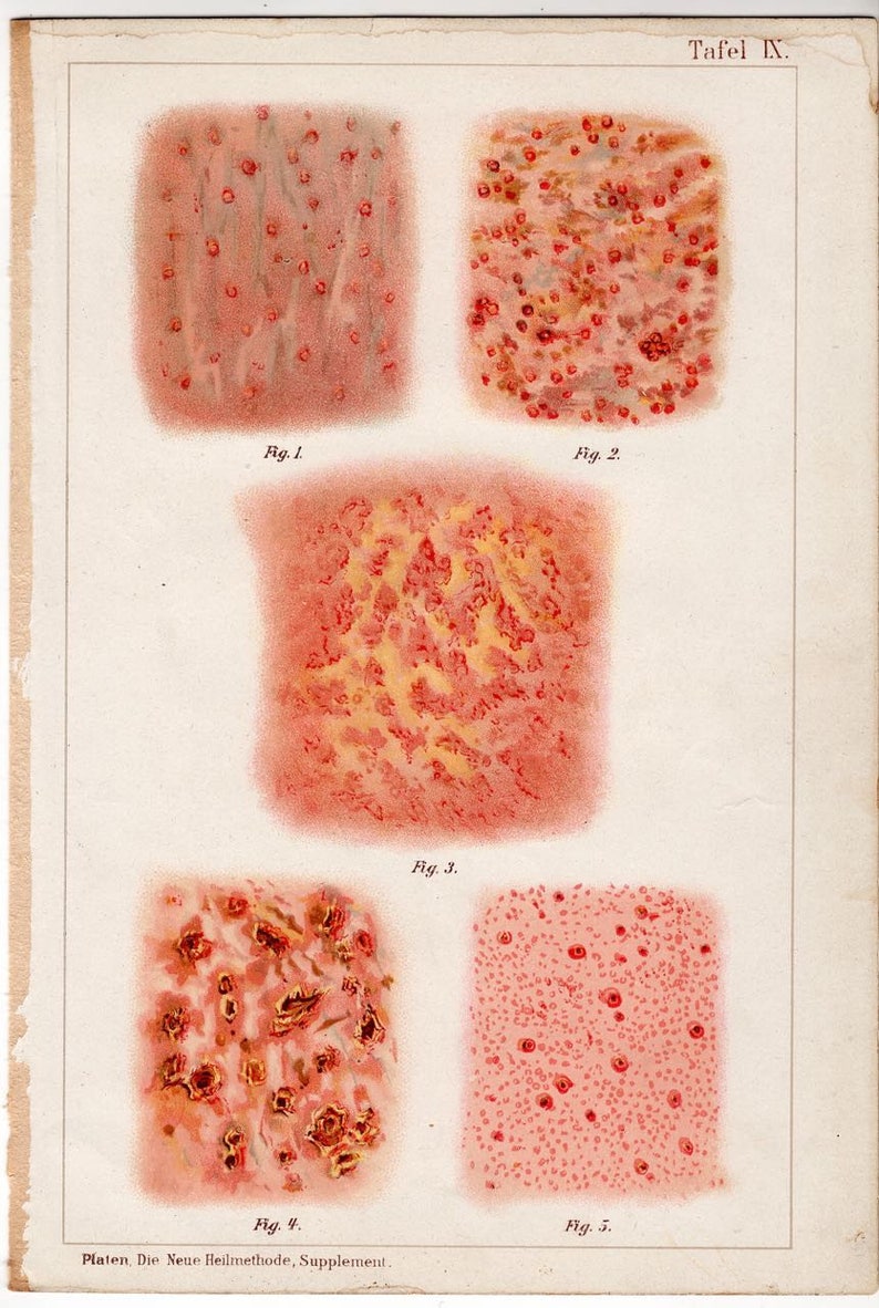 C. 1902 SKIN DISEASE PRINT syphilid syphilis infections | Etsy