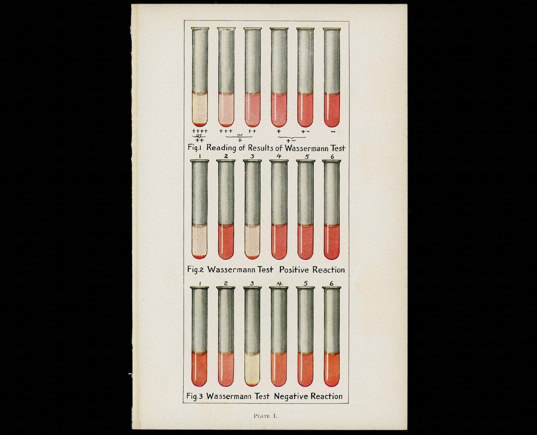 C. 1939 WASSERMANN TEST Lithograph • Test for Syphilis • Original ...
