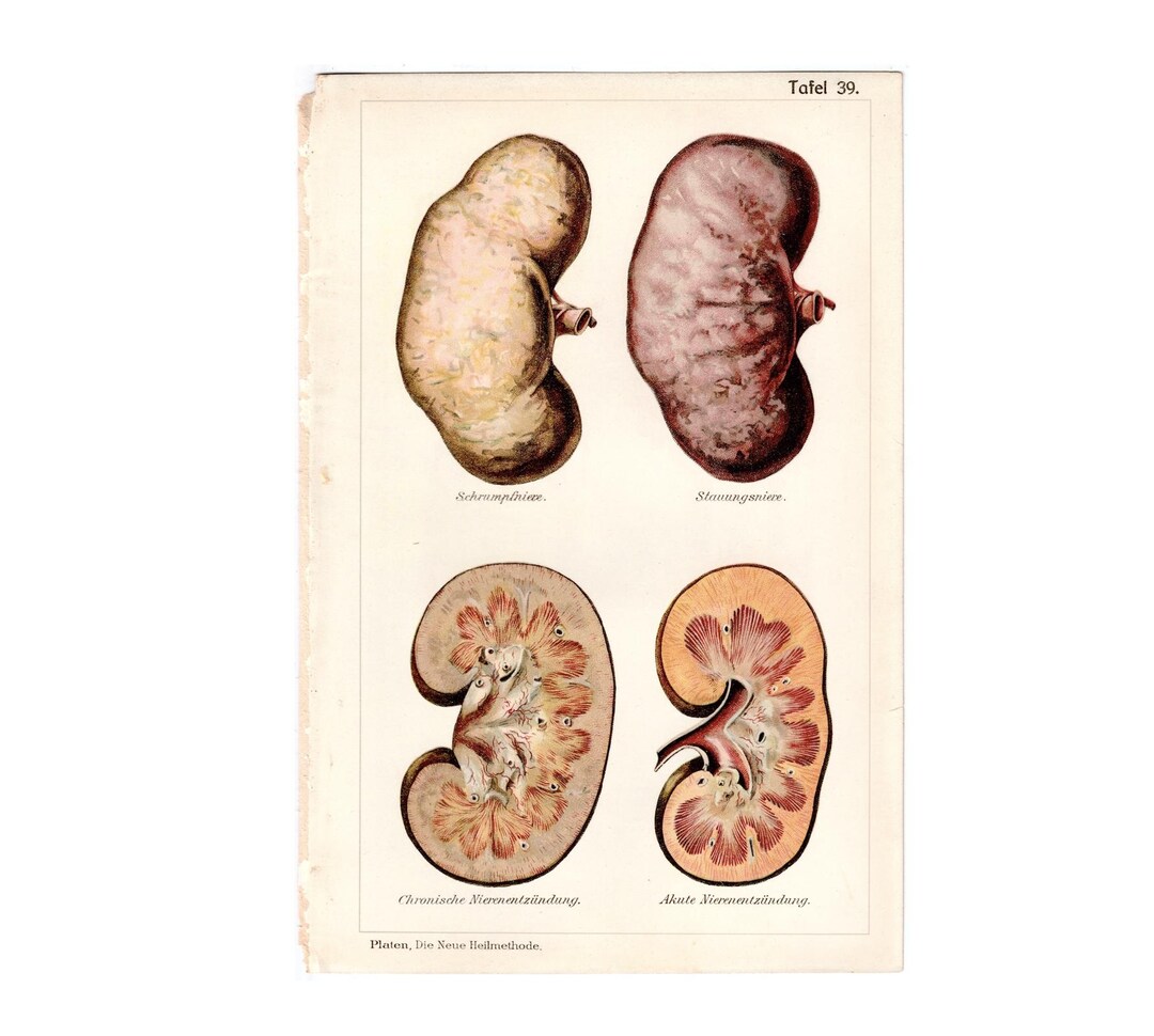 C.1902 KIDNEY DISEASE Lithograph • Original Antique Print • Human ...