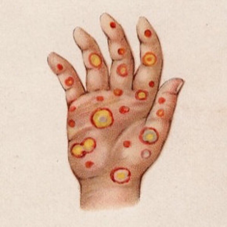 C 1902 Syphilis Print Skin Diseases Print Original Etsy