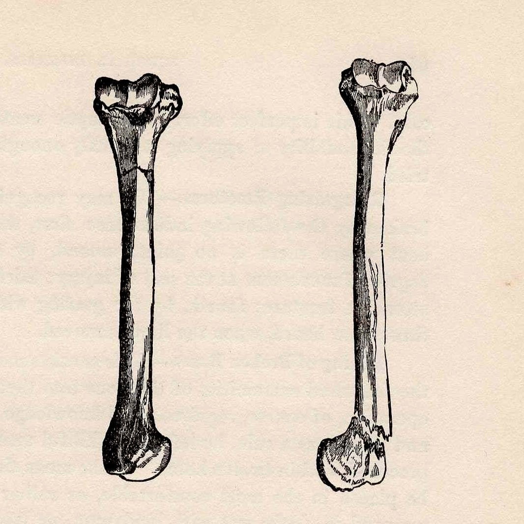 1903 HUMAN ANATOMY BONES Original Antique Anatomy Print of Bone ...