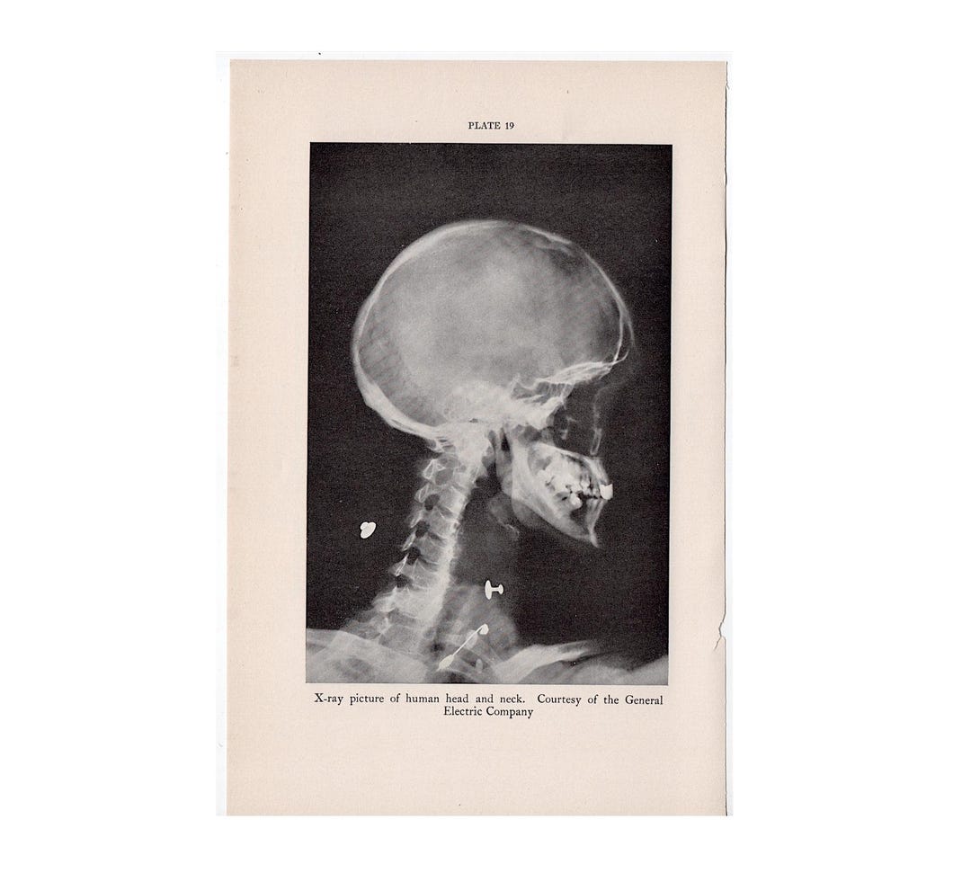 X-RAY HEAD & NECK Print C. 1934 • Original Vintage Print • Human ...