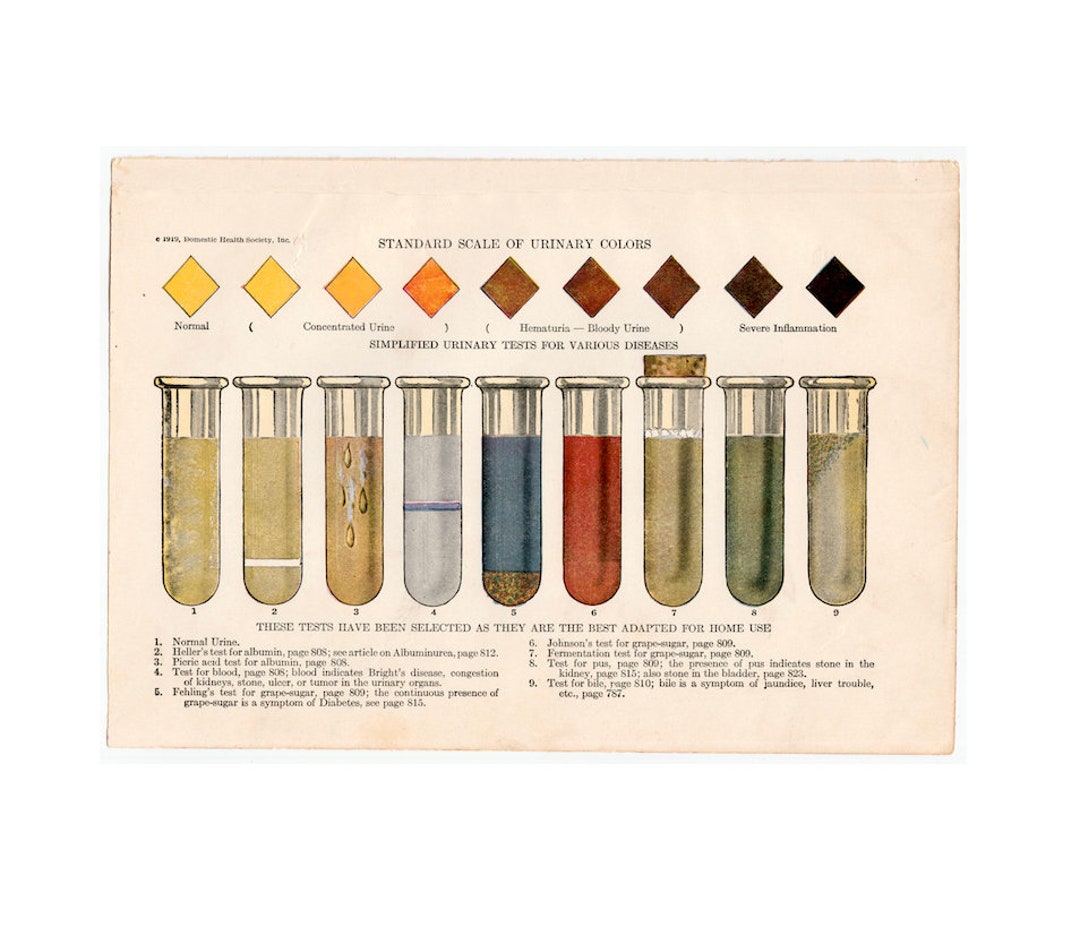 C. 1920 URINALYSIS Lithograph Original Antique Print Medical ...