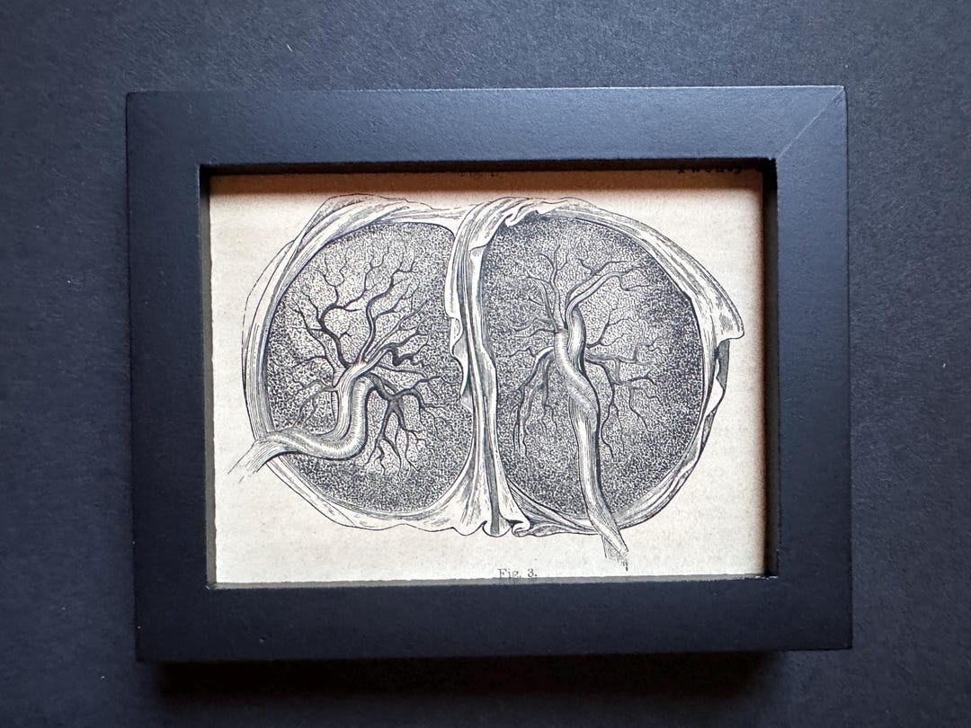 Framed PLACENTA OF TWINS Lithograph C. 1860 • Original Antique Print ...