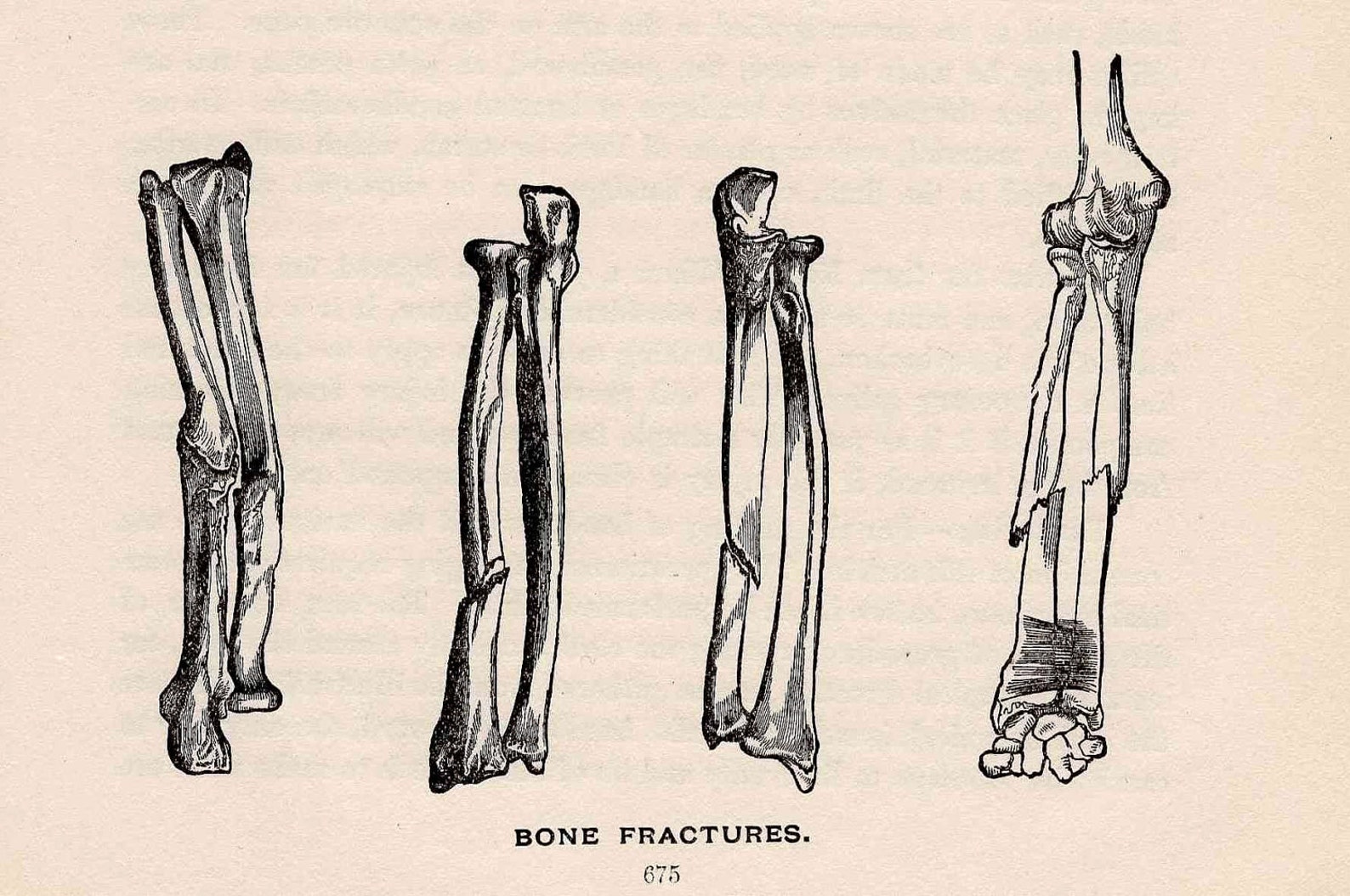 1903 HUMAN ANATOMY BONES Original Antique Anatomy Print of Bone ...