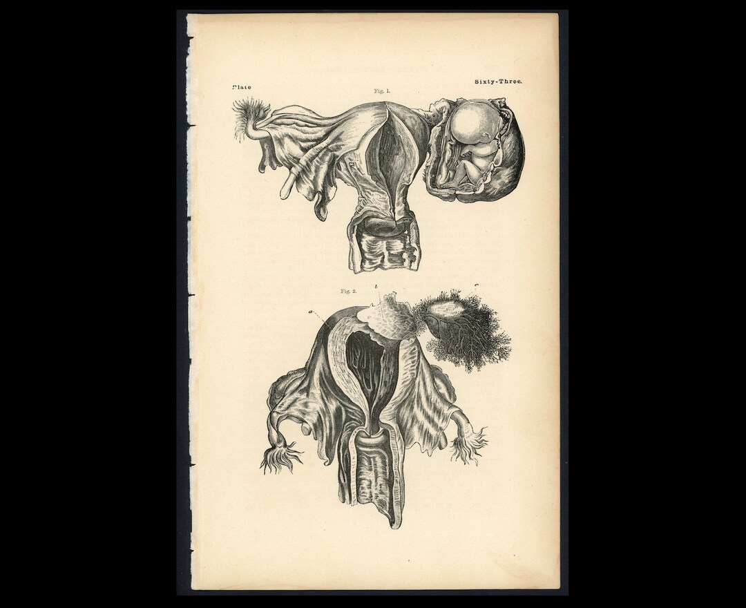 C. 1860 ECTOPIC PREGNANCY Lithograph • Original Antique Print • Fetus ...