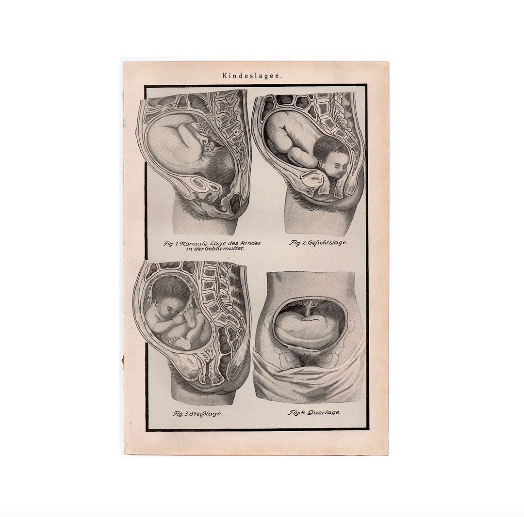 C. 1929 BABY POSITIONS in Womb Print Antique Medical Print Pregnancy ...