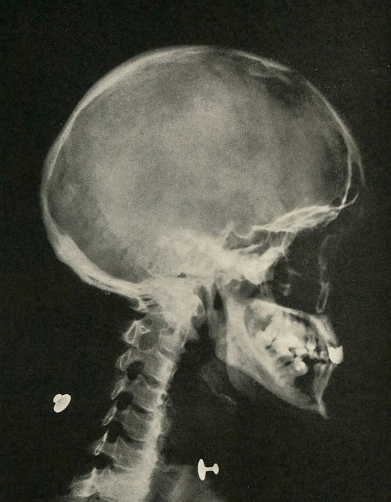 Head X Ray Pictures