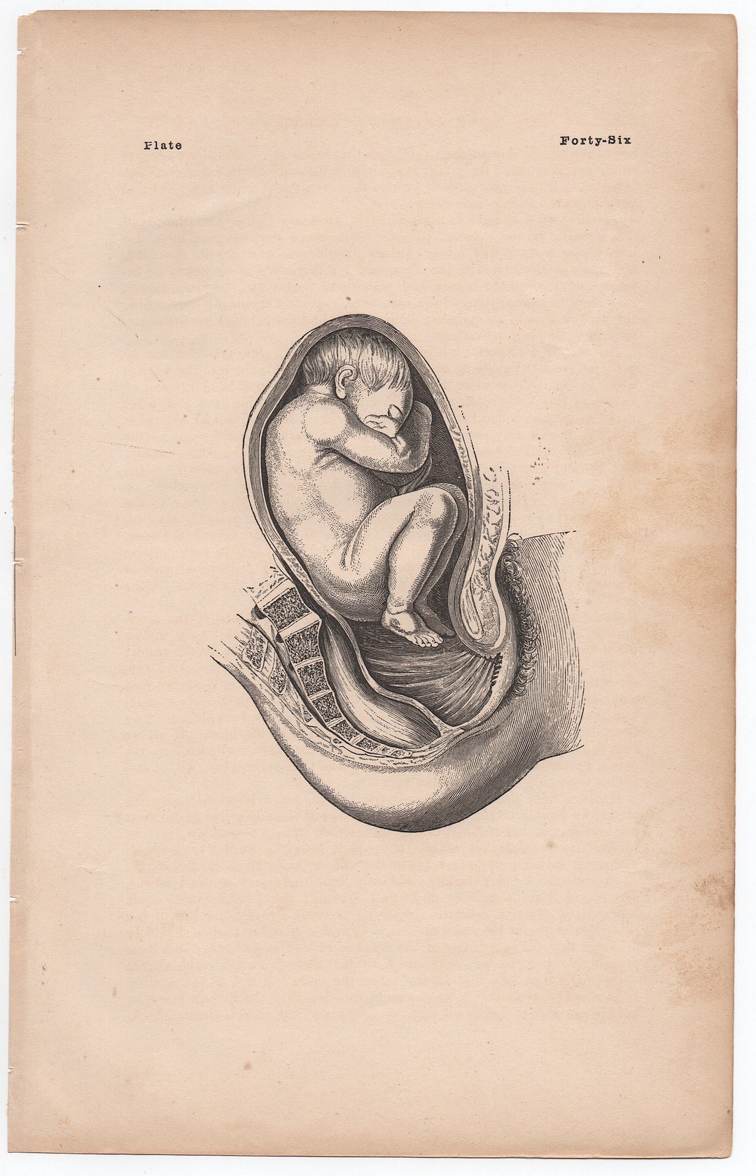 C. 1860 BIRTHING Lithograph • Original Antique Print • Fetus Anatomy ...
