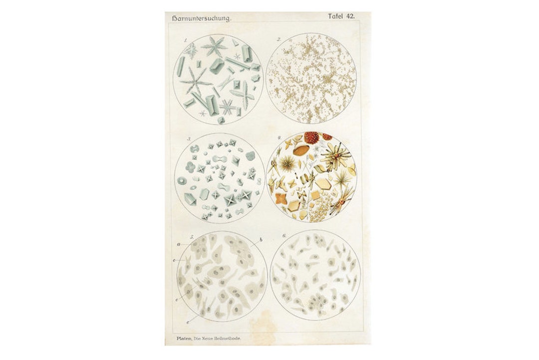 C. 1896 URINE UNDER MICROSCOPE Lithograph Original Antique - Etsy