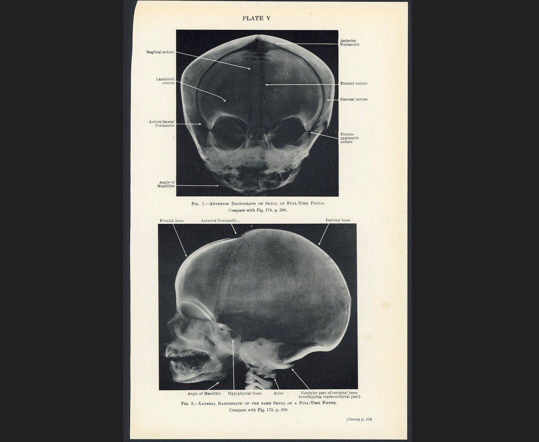 FETUS SKULLS Print C. 1937 • Original Vintage Print • Fetal Anatomy ...