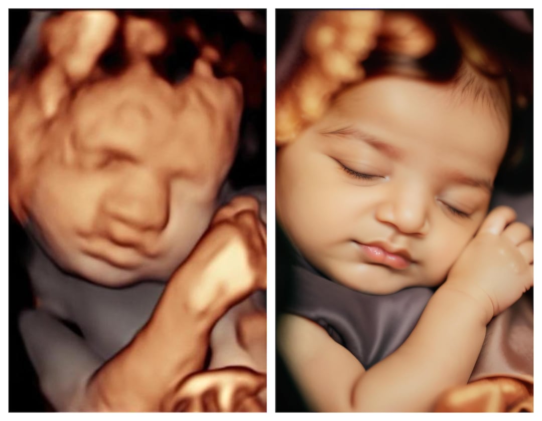 Ultrasound Transformation, Ultrasound Baby, First Baby Photo, 3d 4d 5d ...