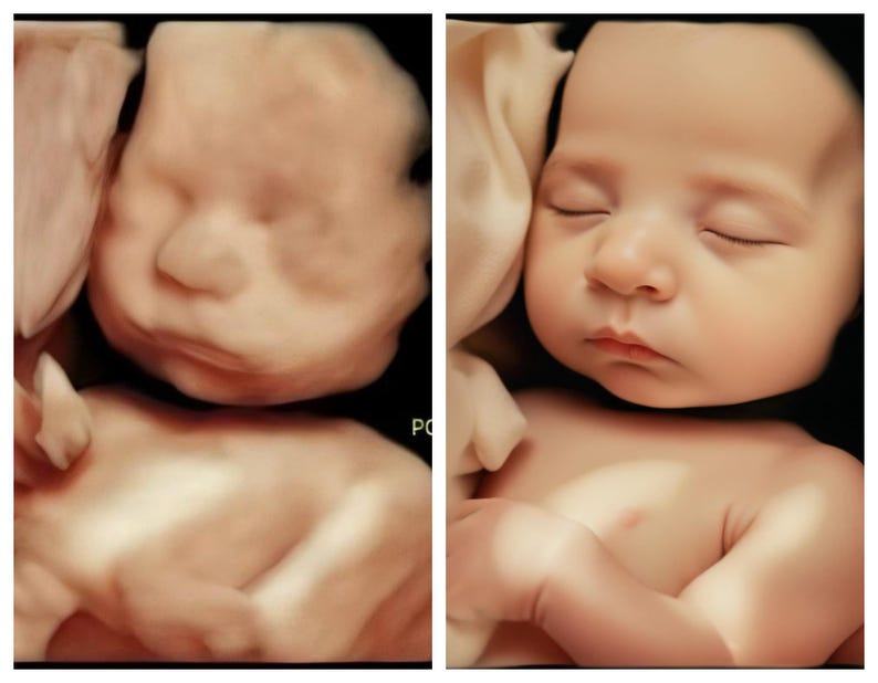 Ultrasound Transformation, Ultrasound Baby, First Baby Photo, 3d 4d 5d ...