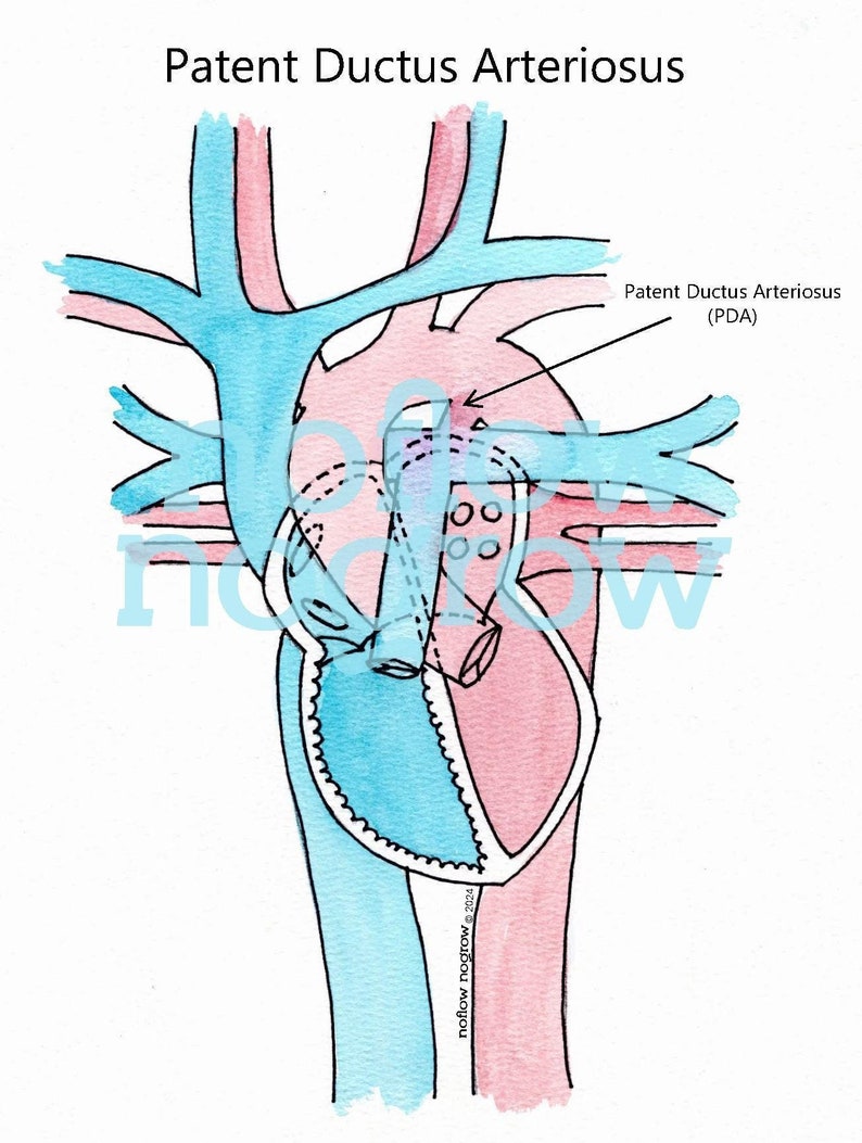 Patent Ductus Arteriosus (PDA) - Etsy