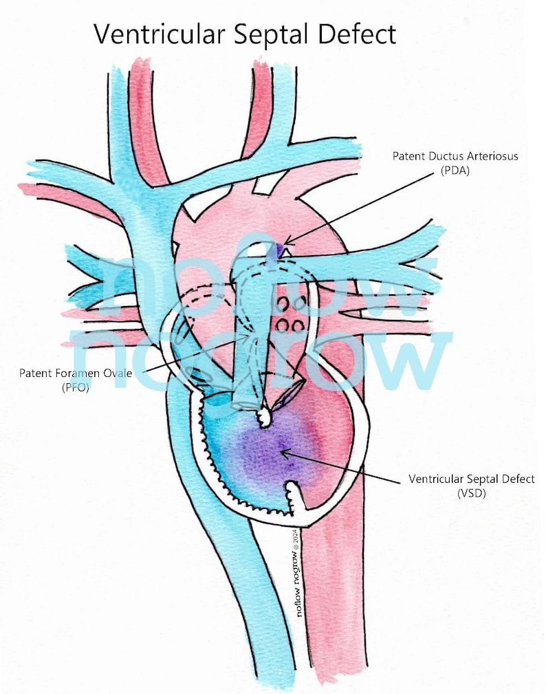 Ventricular Septal Defect Watercolor Illustration (VSD) - Etsy
