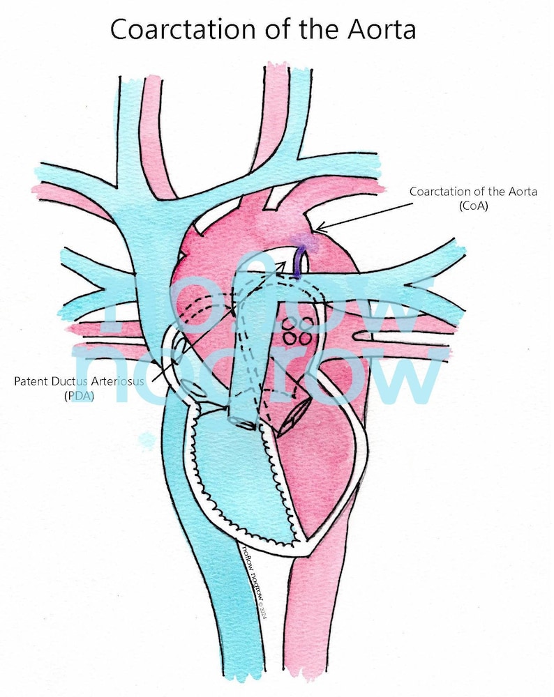 Coarctation of the Aorta - Etsy