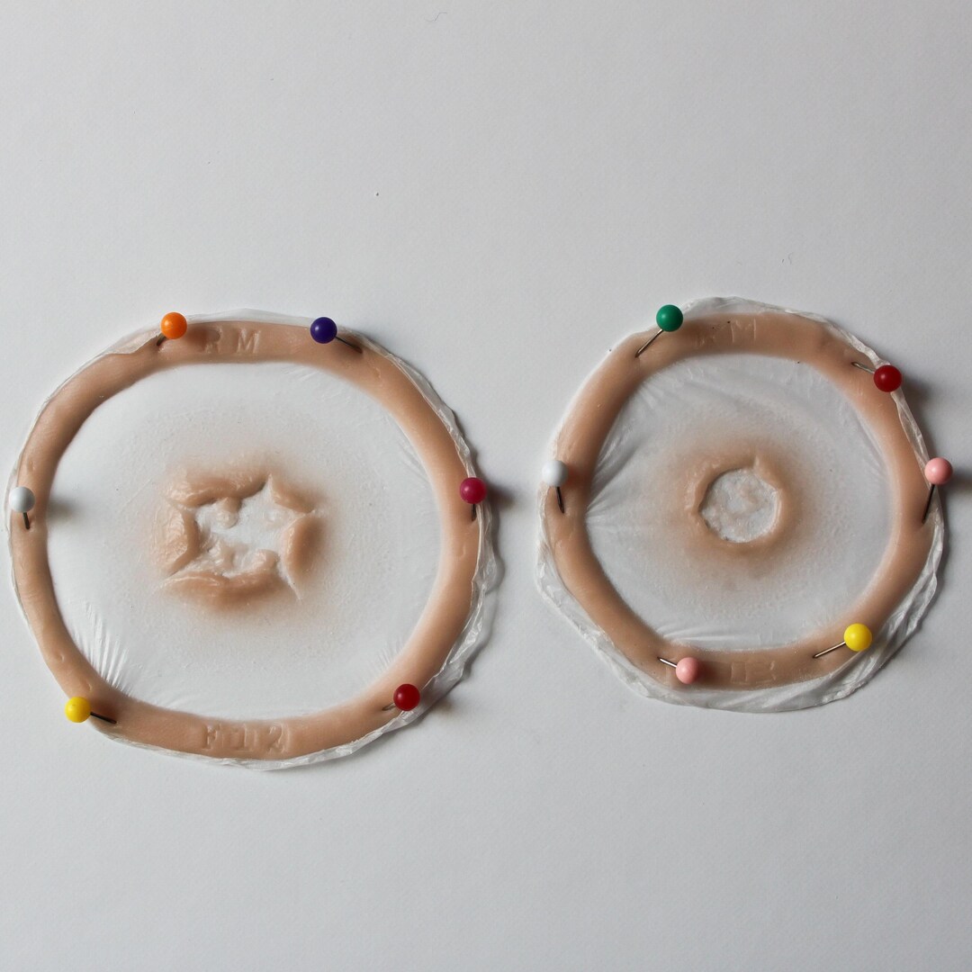 Silicone Encapsulated Prosthesis of Two Gunshot Wounds, Bullet Hole ...