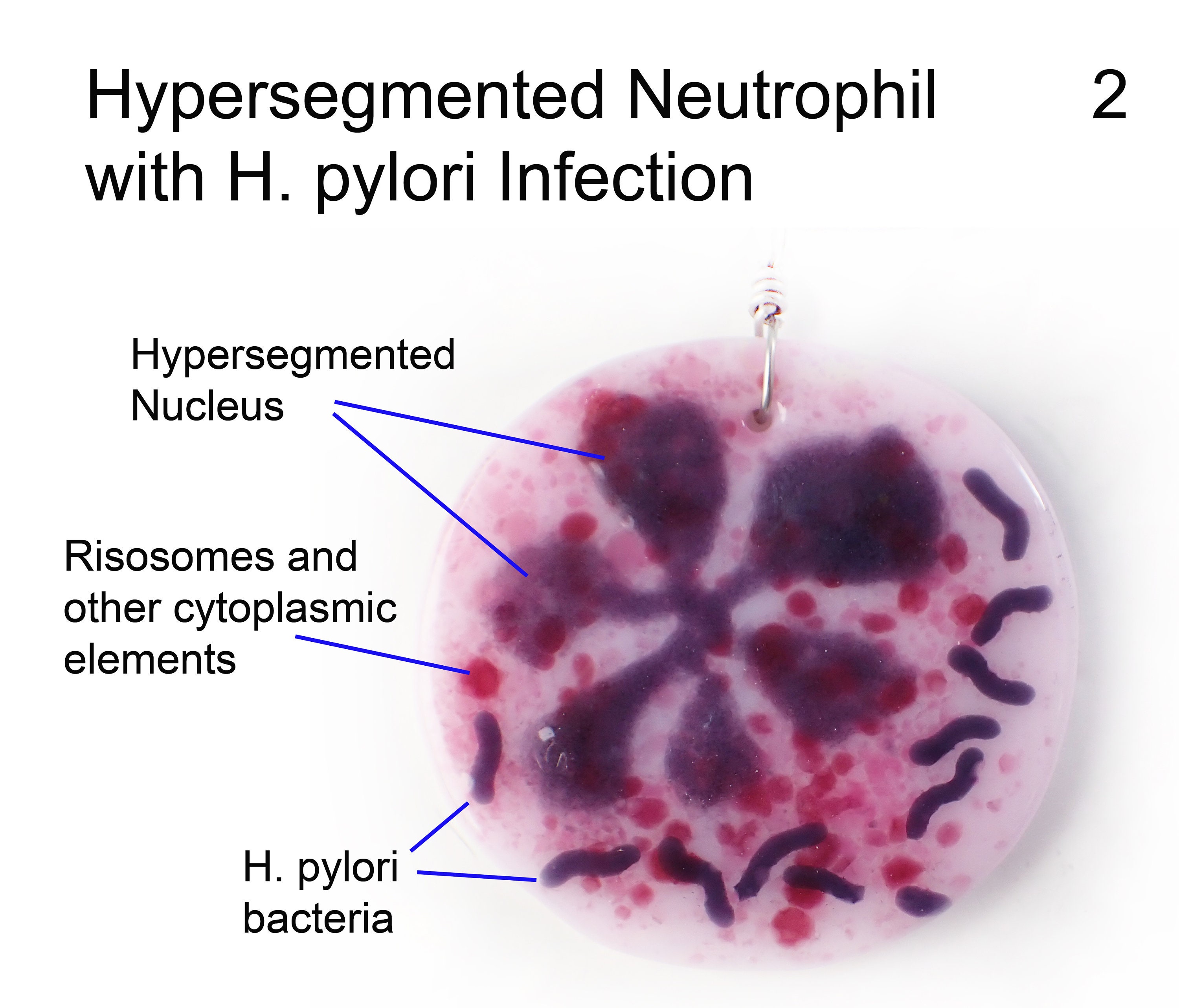 Hypersegmented Neutrophils