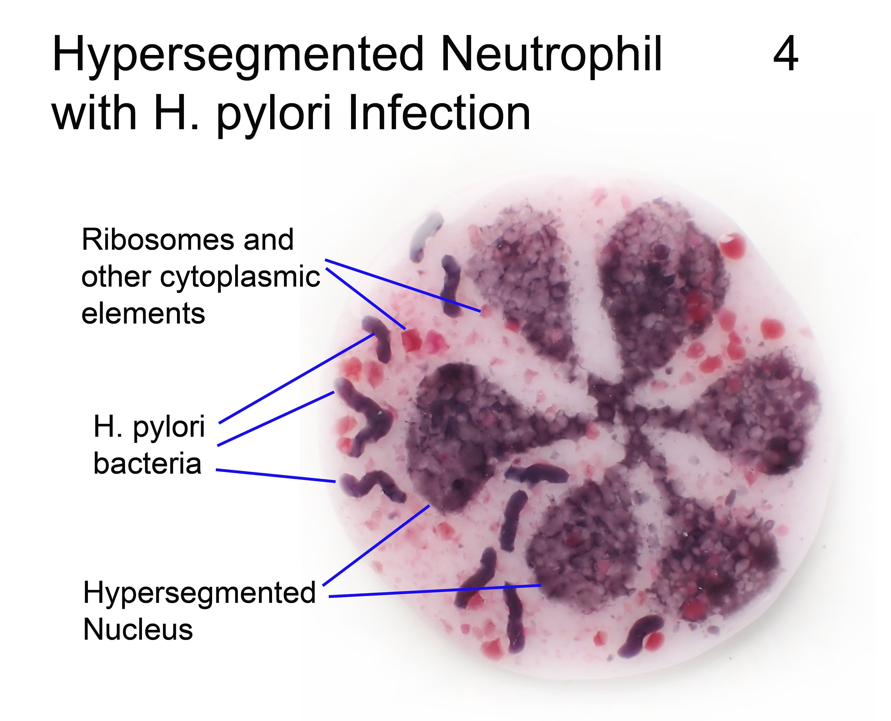 Hypersegmented Neutrophils