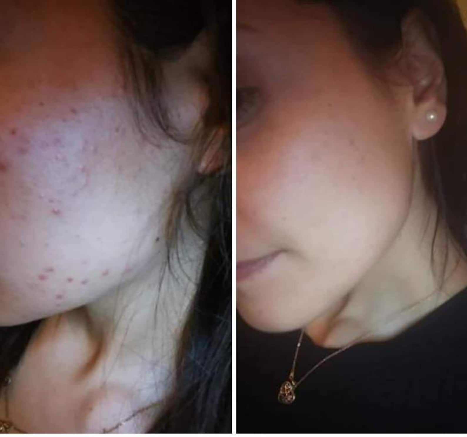 TCA Peel 20% Exfoliating Skin Peel |FREE WORLDWIDE Shipping| – 1 Fl Oz ...