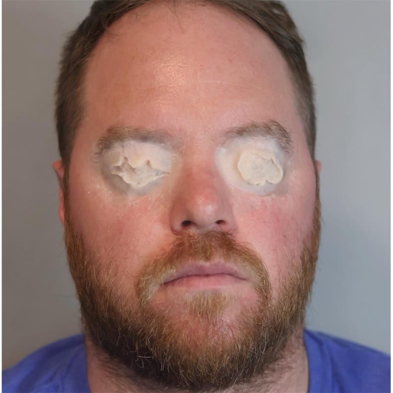 Gouged Eye Prosthetics | SFX Makeup | Wounds - Etsy