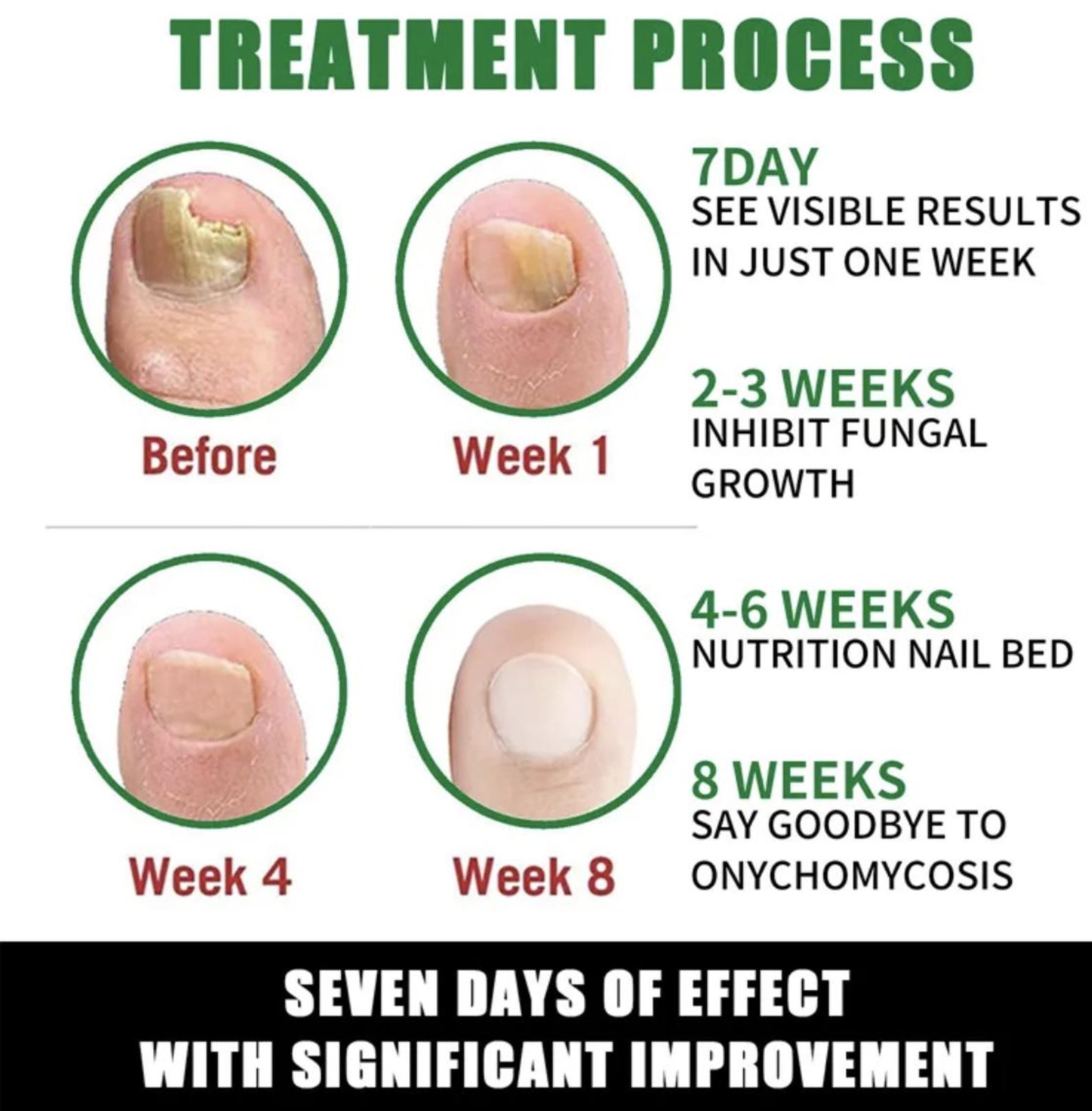 7 Day Nail Fungus Treatment and Cuticle Repair Oil Strengthens and ...