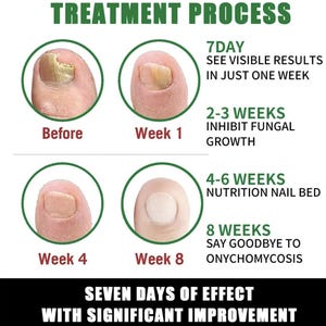 7 Day Nail Fungus Treatment and Cuticle Repair Oil Strengthens and ...